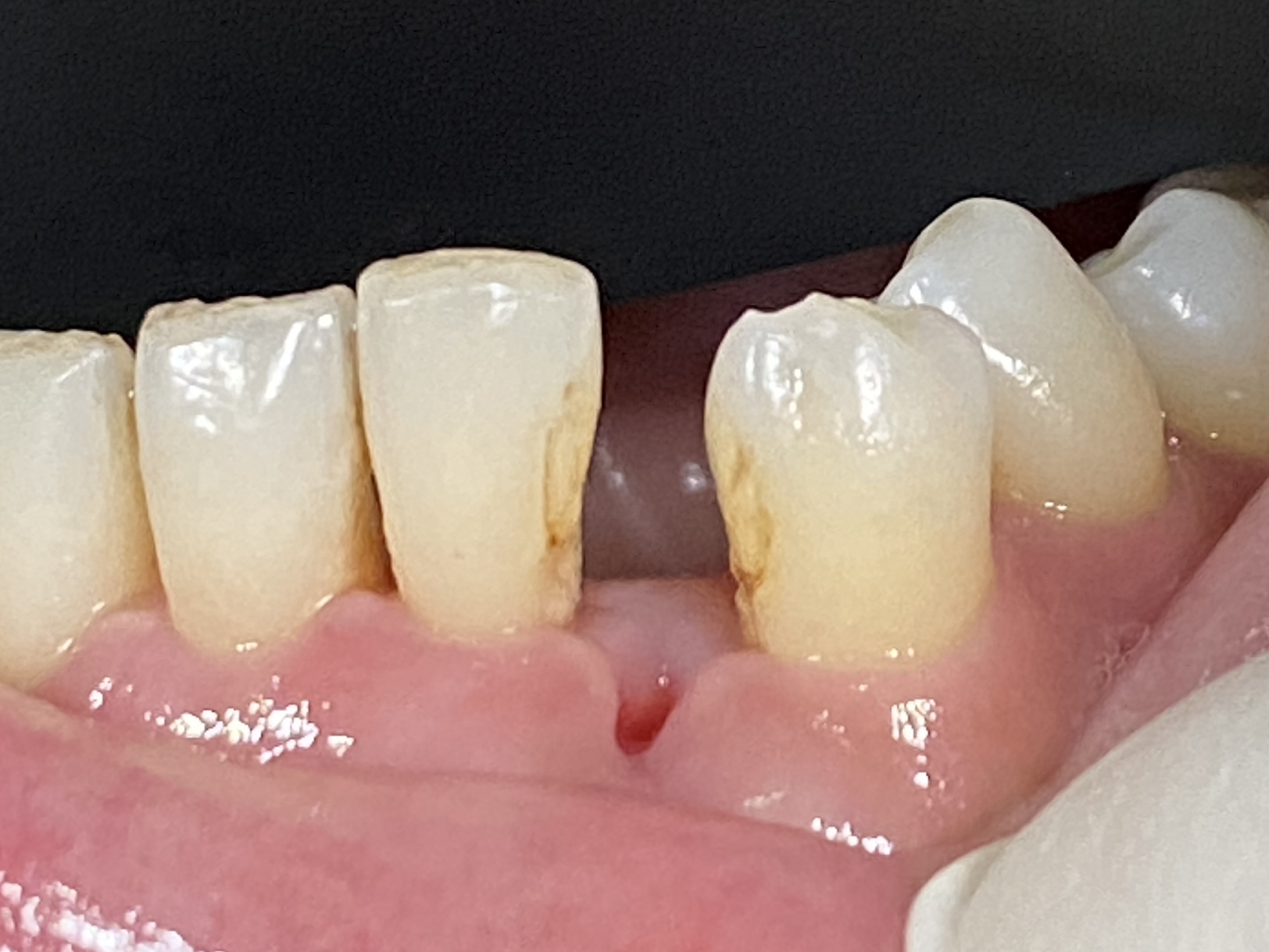 Resin Composite Bridge – Union Dental